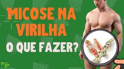 MICOSE NA VIRILHA Tinha cruris remédio caseiro e pomadas que