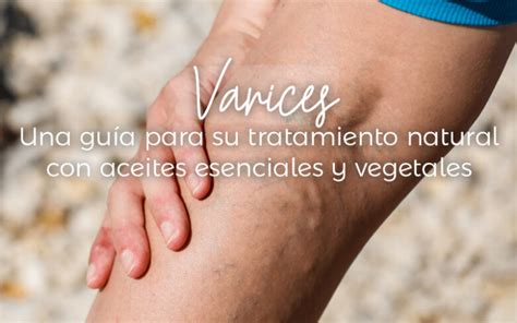 Varices una guía para su tratamiento natural con aceites esenciales y