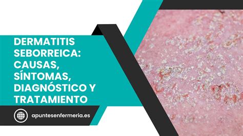 Dermatitis seborreica causas síntomas diagnóstico y tratamiento