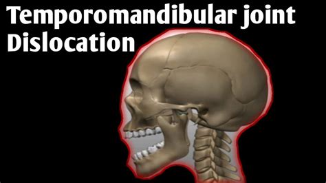 Dislocation Of Mandibular Dislocation Of The Temporomandibular Joint