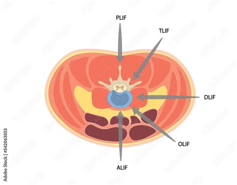 Lumbar Interbody Fusion LIF Spine Surgery Performade By A Endoscopy