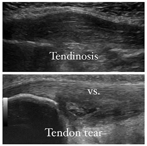 What Characteristics Help Distinguish The Appearance Of Tendinosis From