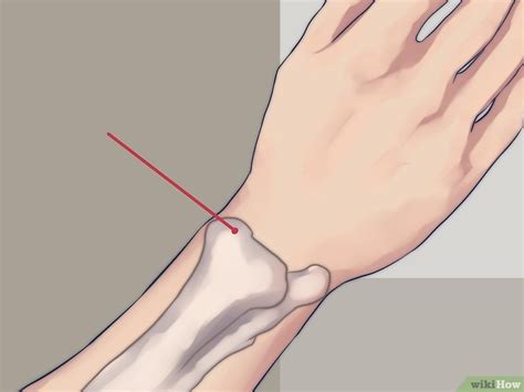 4 Formas De Clasificar Las Fracturas Distales De Radio