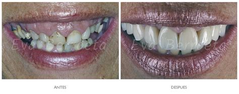 Coronas de porcelana Clínica Dental Clinica Eva Berroeta