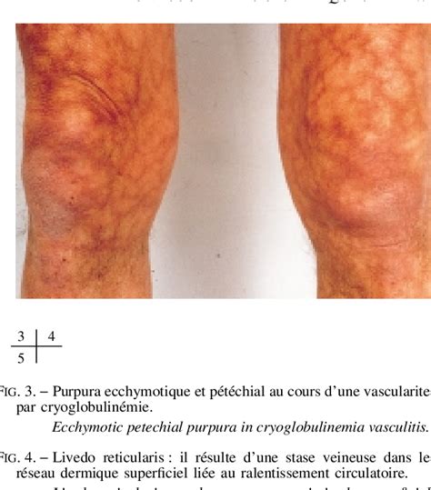 PDF Les vascularites systémiques Semantic Scholar