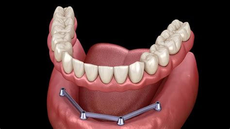 Prótese dentária removível encaixe qual o melhor preço