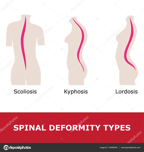 Spinal Deformity Types Stock Vector Image By Paveu