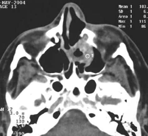 Tomografía axial computada del macizo facial que muestra la lesión en