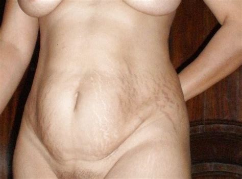Stretch Mark Nudes Photos