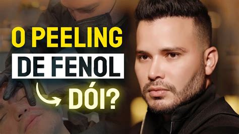A Dor E O Peeling De Fenol Dr Madson Sales Youtube