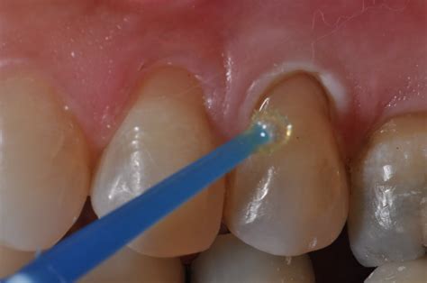 M Vestphal Odontologia Estética Restauração Classe V Resina