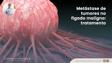 Metástase de tumores no fígado maligno tratamento Prof Dr Luiz