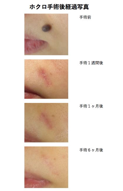イボ・ホクロ治療（手術） 秋葉原スキンクリニック