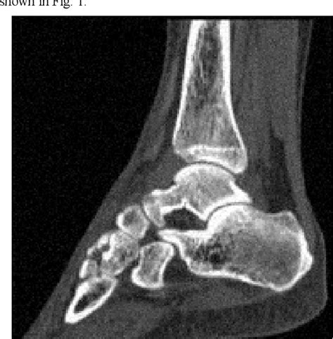 figure 1 from medical ankle image denoising based on constrained least square filter semantic