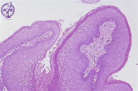 Female Genital Organs Condyloma Acuminatum Of The Vulva