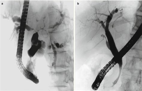 igg4 related sclerosing cholangitis basicmedical key