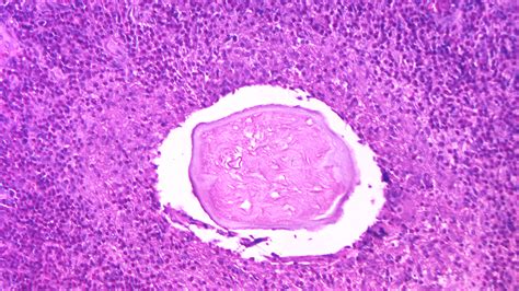 About Dirofilariasis Dirofilariasis CDC
