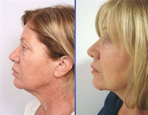 Best Facelift Offers Meditravel