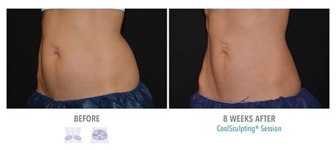 What To Do After Coolsculpting For Best Results