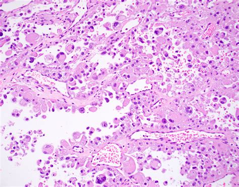 Pathology Outlines Alveolar Soft Part Sarcoma