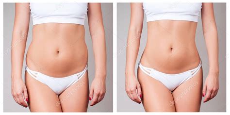 Cuerpo femenino antes y después del tratamiento Cirugía plástica 2023