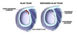 Mr Paul Jarrett Biceps Tendon Pathology At The Shoulder Murdoch