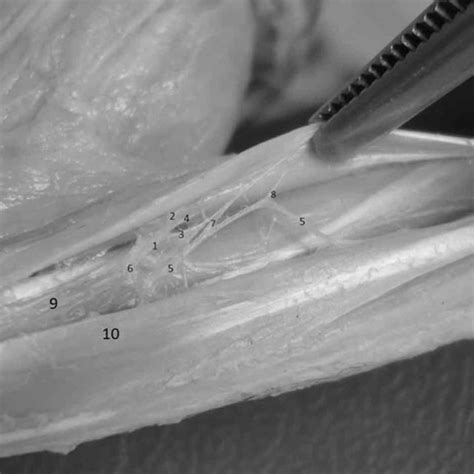 Lateral View Of The Right Forearm Of A Specimen The Superficial