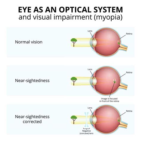 Myopia What It Is And How To Correct It Bdp Lasik