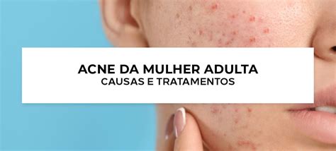 ACNE DA MULHER ADULTA CAUSAS E TRATAMENTO Blog Ada Tina