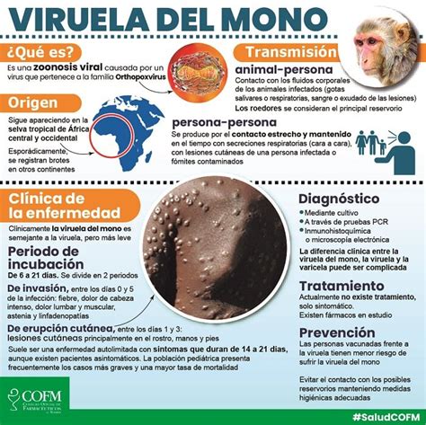 Viruela de los monos o viruela símica blog COFM