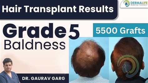 Hair Transplant Grade Before And After Result Months Result