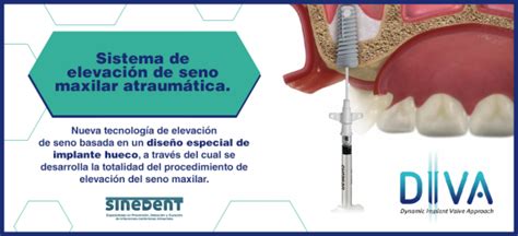 DIVA la nueva tecnología de elevación de seno atraumática de Sinedent
