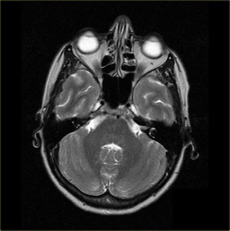 The Radiology Assistant Brain Anatomy In 2020 Brain Anatomy