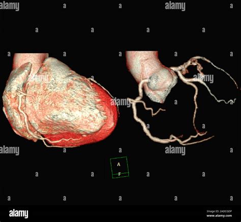 El corazón y la evaluación de la arteria coronaria 3D color tomografía
