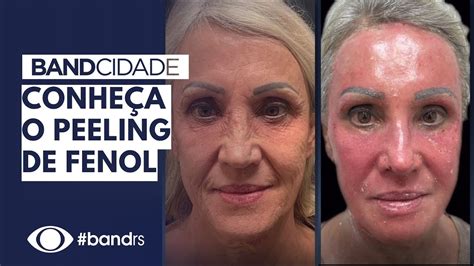 Peeling de Fenol vídeo de procedimento viraliza nas redes sociais