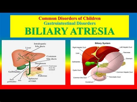 Biliary Atresia Define Causes Pathophysiology Clinical Features