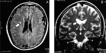A Axial FLAIR MRI Mild Rounded Foci Of High Sign Int Open I