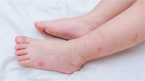 Nguyên nhân và cách giải quyết khi trẻ bị nổi mẩn đỏ như muỗi đốt