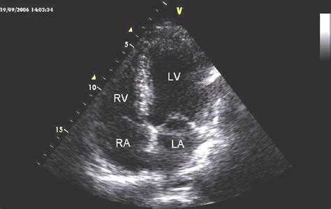 Acute Left Ventricular Free Wall Rupture During Echocardiography