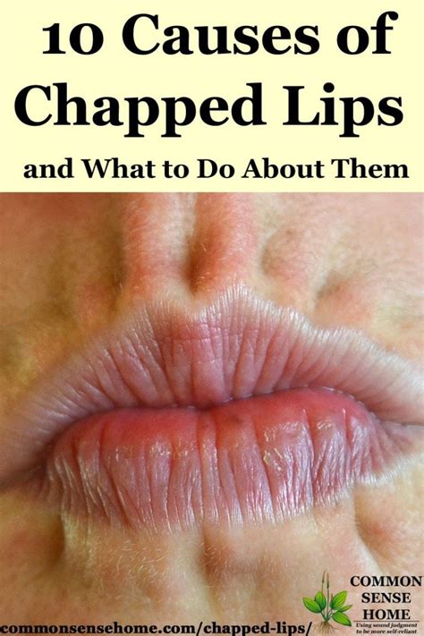 10 Causes Of Chapped Lips Plus How To Get Rid Of Chapped Lips