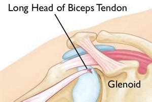Biceps Tendon Tear At The Shoulder New Mexico Orthopaedic Associates