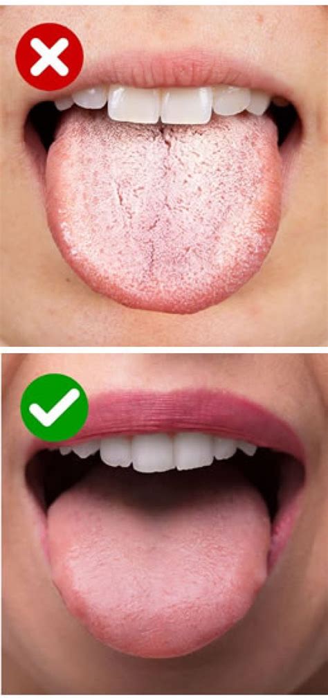 Lengua Blanca Qué es Síntomas Tratamiento Clínica Dental en