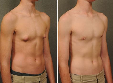 Male Gyno Surgery Cost Porn Pics Sex Photos Xxx Images Pisosgestion