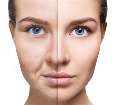 Flacidez Facial qué es síntomas y tratamiento Top Doctors