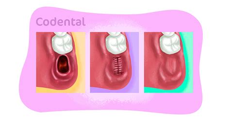 Cicatriza O Do Siso Tudo Que Voc Precisa Saber Codental Blog