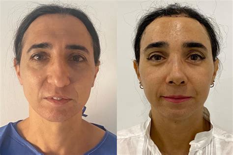 Resultados de Cambio de Sexo Cirugías de Género