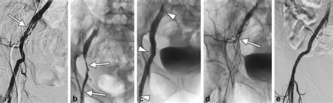 Wire Access Preservation Facilitates The Management Of External Iliac
