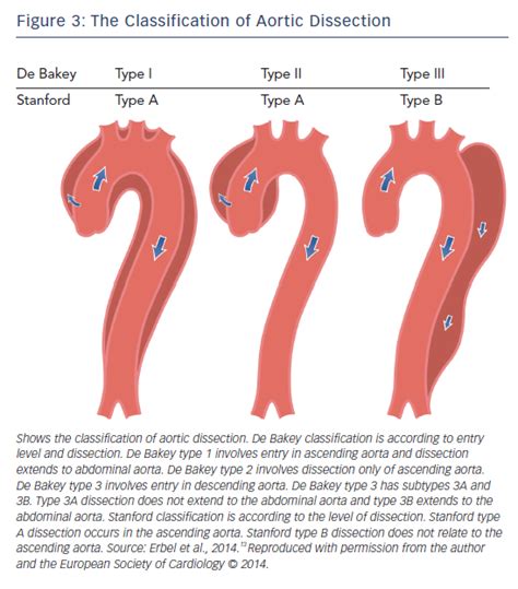 Figure 3 The Classification Of Aortic Dissection Radcliffe Vascular