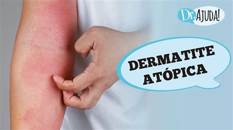 DERMATITE ATÓPICA O QUE VOCÊ PRECISA SABER SOBRE ISSO