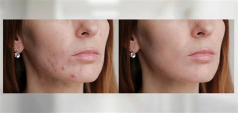 Does Azelaic Acid Cause Purging Or Not Know It All